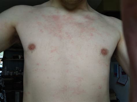 Full Body Raynauds R Scleroderma