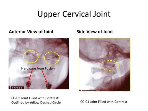 Joint Health And Function Implications Of Surgical Fusions