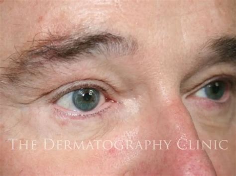 Permanent Makeup Eyeliner And Lashline Tattoo For Men