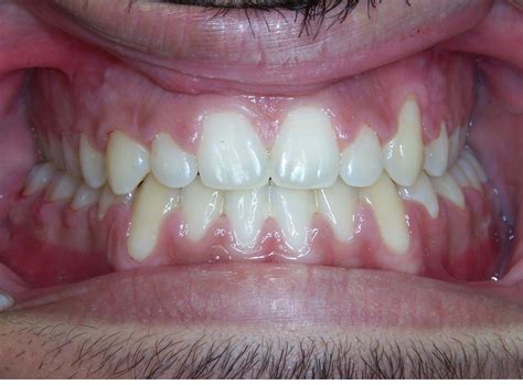 Open Bite Orthognathic Surgery Jaw Surgery Before And After Gallery