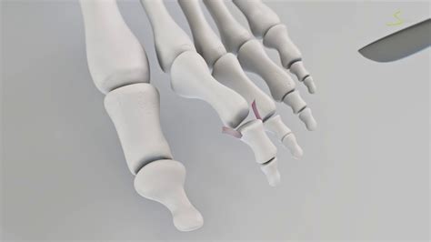 Pip Arthrodesis With Magnezix® Starfuse® [en] Youtube