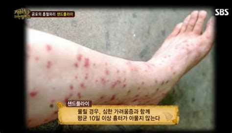 모기의 20배 흉터만 1년” 최악의 흡혈곤충 샌드플라이