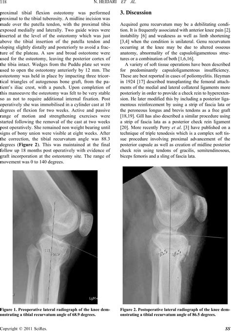 Report Of A Case Of Genu Recurvatum Following Tibial Eminence Avulsion Treated By Proximal