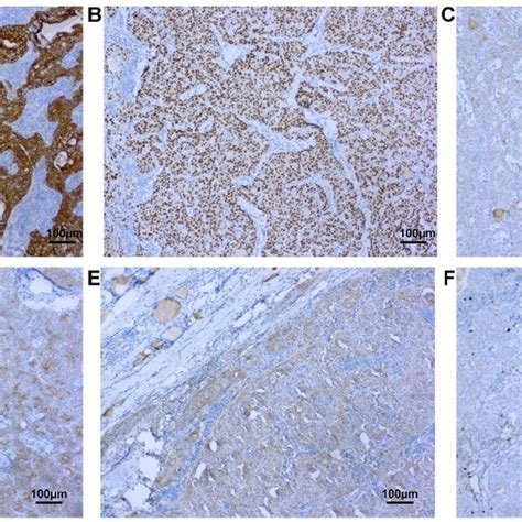 Immunohistochemistry Ihc Results Of Case 1 Ihc 100× A The Tumor