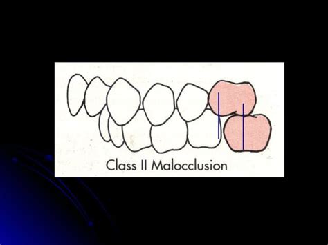 Classification Of Normal Occlusion And Malocclusion Ppt Dental