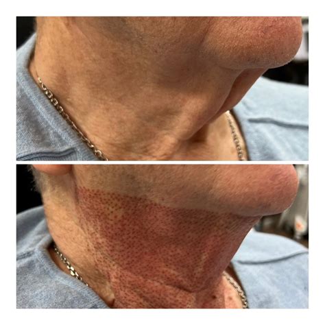 The Ultimate Guide To Plasma Fibroblast Anti Aging Skin Treatment Aftercare