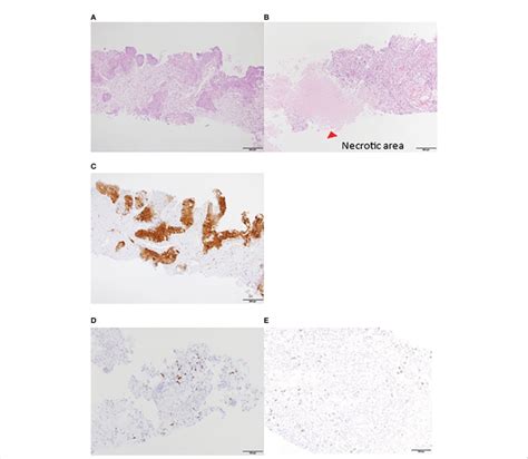 Liver Biopsy Tissue He Staining Increased Necrotic Area After