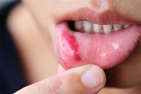 Canker Sore During Pregnancy Causes Treatment And Prevention