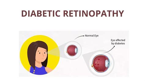 Planning To Get Diabetic Retinopathy Treatment Here Is Everything You