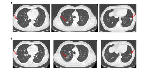 Ct Scan Images Showing Bilateral Lung Metastases Relapsed After