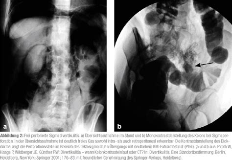 Bildgebende Diagnostik Der Sigmadivertikulitis Deutsches Ärzteblatt