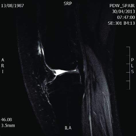 Sagittal Fat Suppressed Proton Density Weighted Image Of The Left Knee