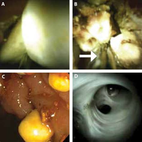 Applications Limitations And Expansion Of Cholangioscopy In Clinical