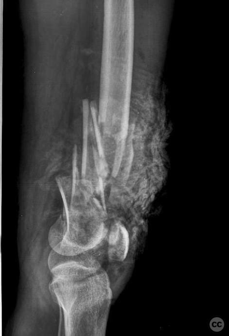 Double Plate Fixation Of A Comminuted Supra And Intercondylar Distal Femur Fracture