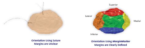 Vector Surgical On Twitter Marginmarker Is A Sterile Ink Kit That