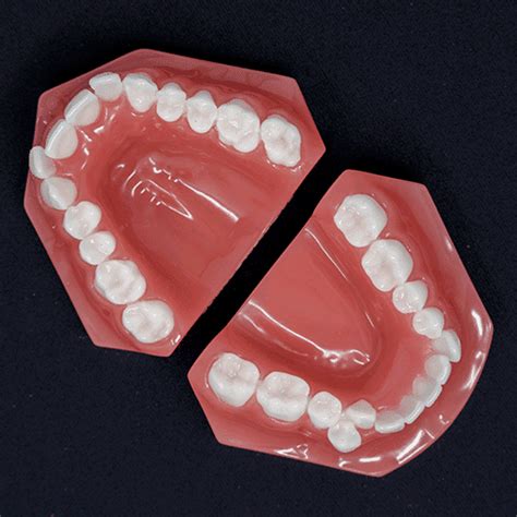 Orthodontic Typodont Class 2 Division 2 Permanent Dentition