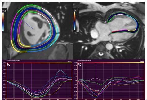 segmental cmr feature tracking in the short and long axis of the rv