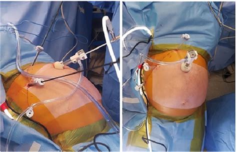 Laparoscopic Port Placement Noting Superior Placement Of 10 Mm Hasson