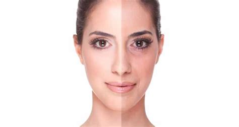 Sclerotherapy Before During And After A Session