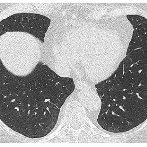 Typical Ct Features Of Intrapulmonary Lymph Node In The Left Lower