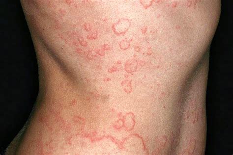 Urticaria Artofit