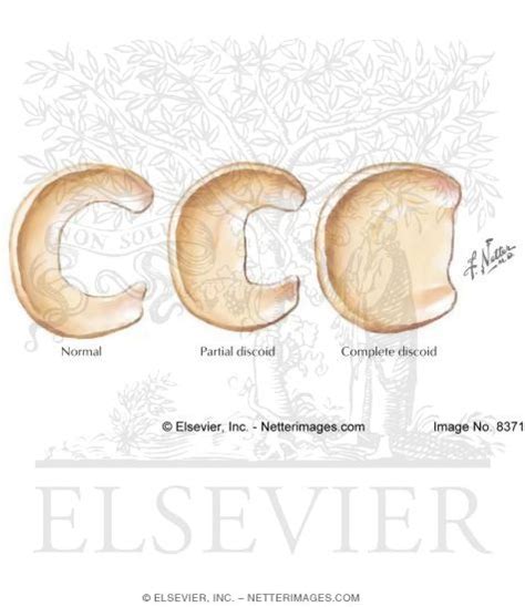 Discoid Meniscus Variations