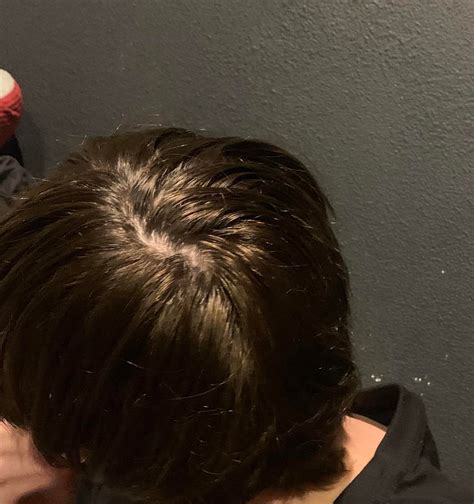 My Biopsy Results Came Back As Adrogenetic Alopecia She Gave Me Spiro 100mg And Mentioned