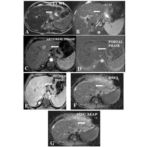 A 60 Year Old Male Patient Post Transarterial Chemoembolization A An