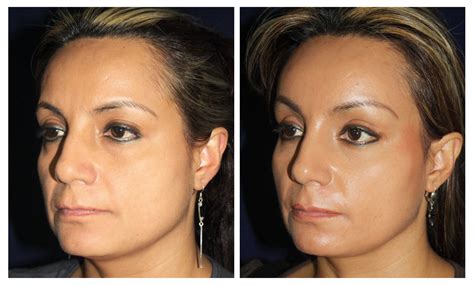 Estiramiento o Lifting Facial Endoscópico