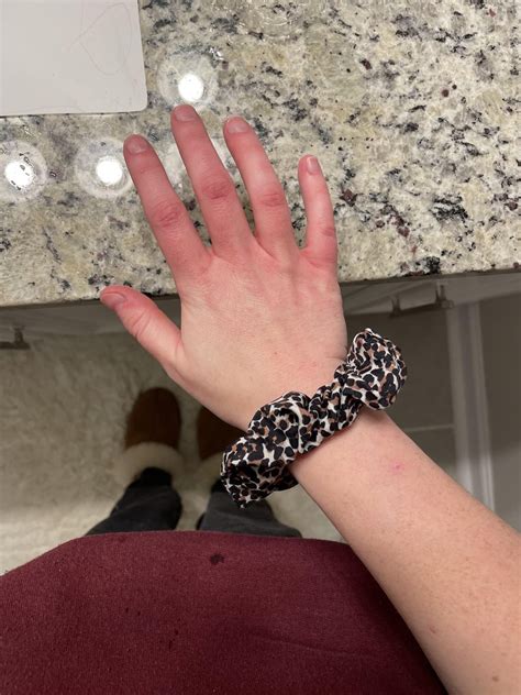 Anyone Have Similar Rash Distribution Not Yet Diagnosed R Erythromelalgia