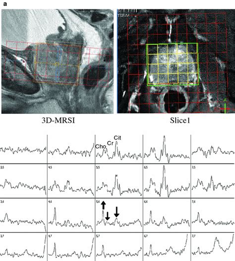 Imaging And Mr Spectroscopy In Prostate Cancer Radiology Key