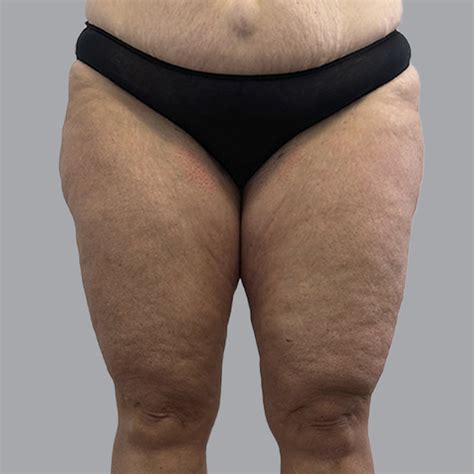 Lipedema Before And After Photos Markelov Md