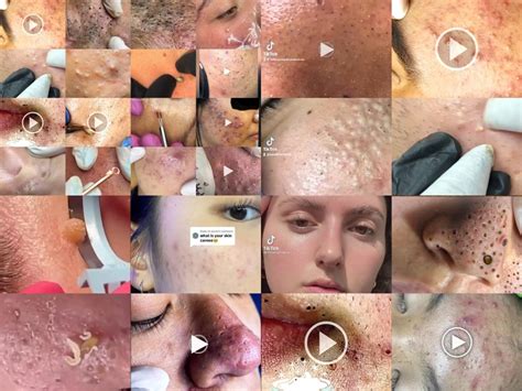 How To Remove Blackheads And Pimples From Your Face Naturally Dicas E