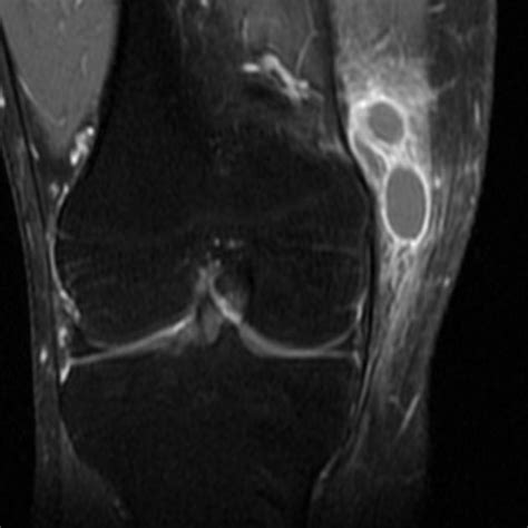 Cyst Like Lesions Around The Knee Pacs