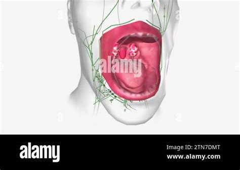 Strep Throat Is Caused By Infection With A Bacterium Known As