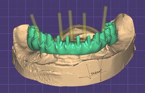 Lucas De Paula On Linkedin Exocad Dental Smiledesign Zirkonzahn