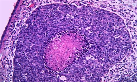 New Biomarkers Found In Rare Bladder Cancer Types Emj