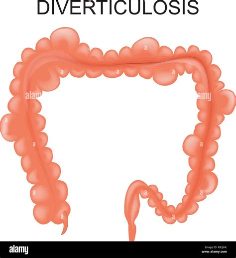 Vector Illustration Of Diverticulosis Of The Colon Stock Vector Image