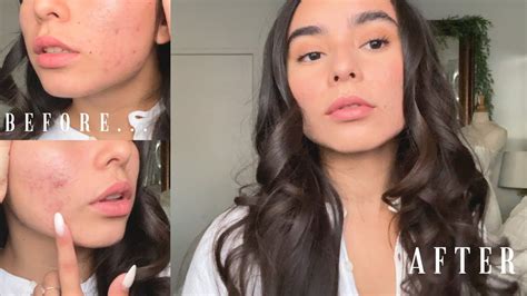 My Everyday Makeup With Acne Prone Skin YouTube