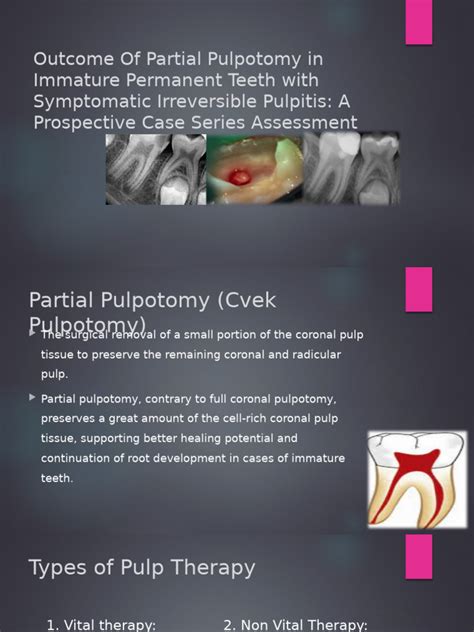 Partial Pulpotomy Bdj Joe New Pdf
