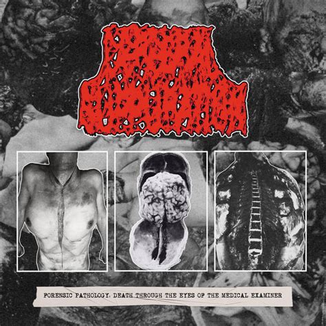 Embryonal Rhabdomyosarcoma Sarcoma Botryoides Cerebral Suppuration