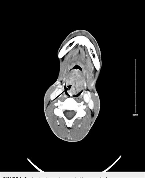 Figure 2 From A Case Of Non Cutaneous Kaposi Sarcoma Semantic Scholar