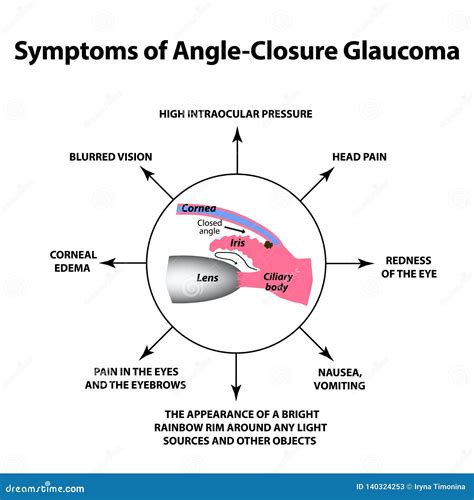 The Symptoms Of Closed Angle Glaucoma World Glaucoma Day The