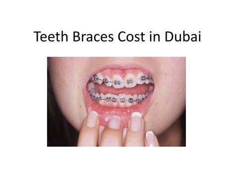 Ppt Teeth Braces Cost In Dubai Powerpoint Presentation Free Download