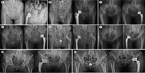 Anteroposterior Ap Pelvic Radiographs Of All 8 Patients In The