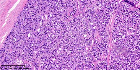 病例分享 胰腺腺泡细胞癌 医学界 助力医生临床决策和职业成长