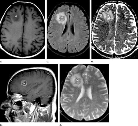 Disseminated Alveolar Echinococcosis In A 36 Year Old Man A B Axial