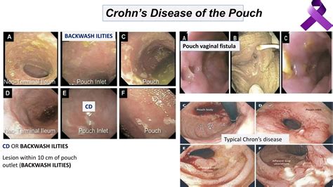 Ulcerative Colitis Complications Management Pptx
