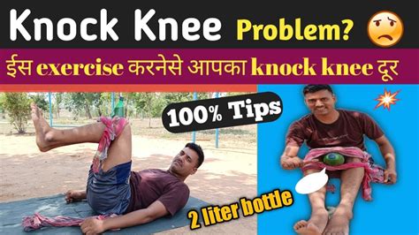 Knock Knee Problem Solution Knock Knee Kaise Thik Kare Only 1