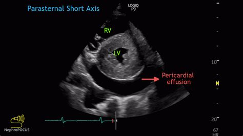 Pericardial Effusion Echo